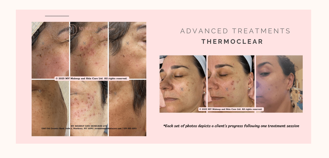 ThermoClear RF vs. Electrodesiccation: Navigating Your Options for ...